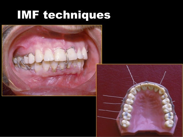 07 mandible, means of imf, imp vs hand holding