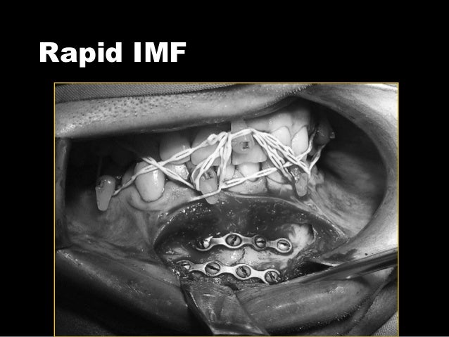 07 mandible, means of imf, imp vs hand holding