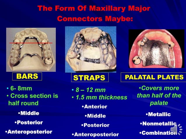 Maxillary major connectors | PPT