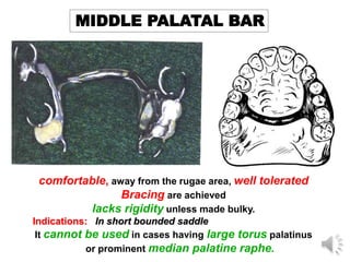 Maxillary major connectors | PPT
