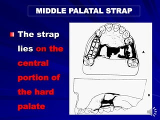 Maxillary major connectors | PPT
