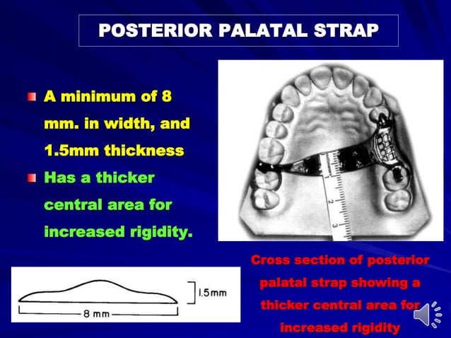 Maxillary major connectors | PPT