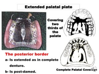 Maxillary major connectors | PPT
