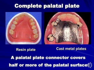 Maxillary major connectors | PPT