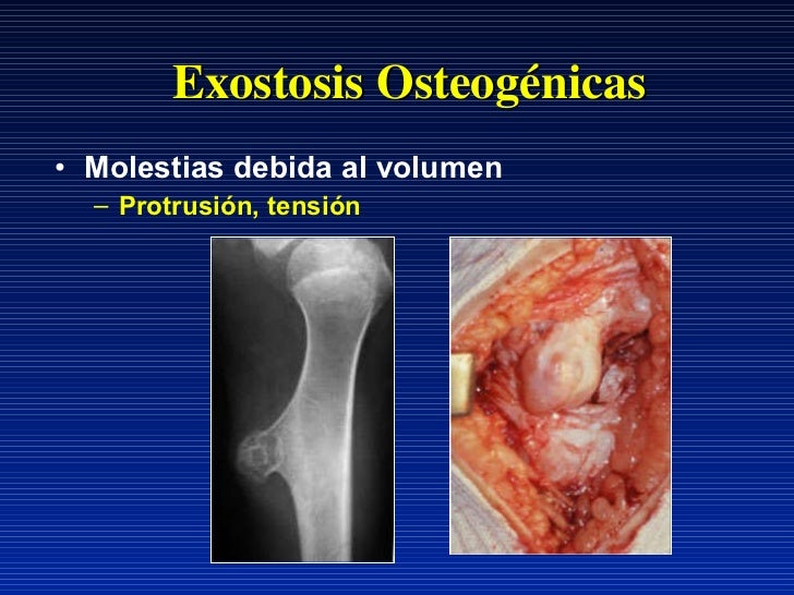 Osteocondromas