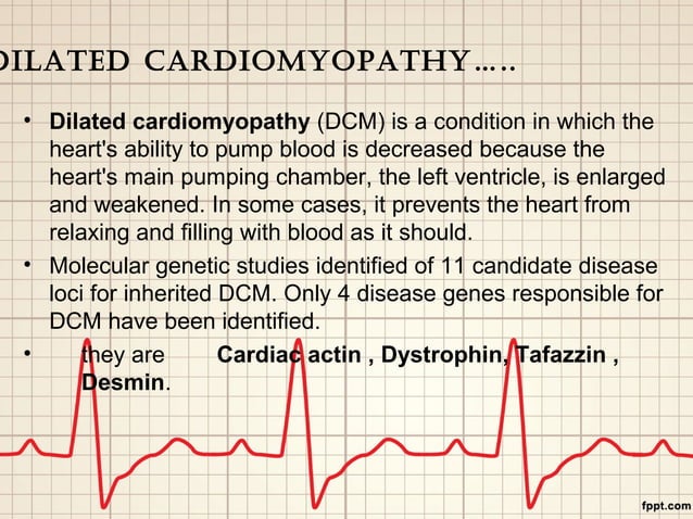 dilated cardiomyopathy | PPT