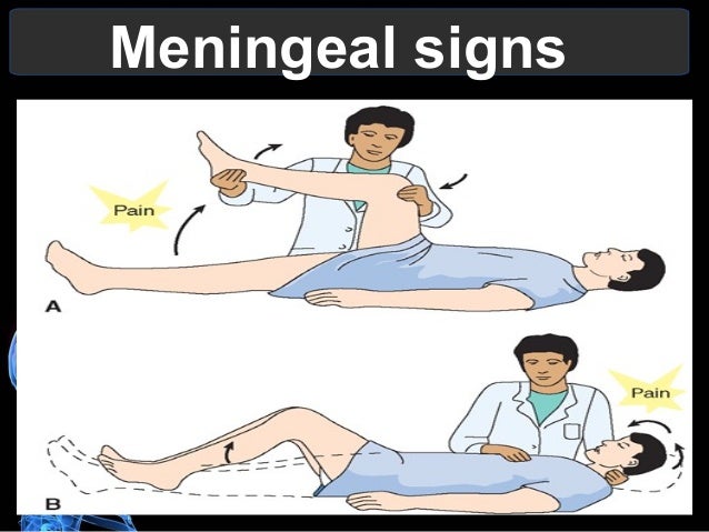 Headache with meningeal signs ppt