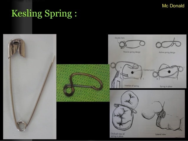 Ectopic eruption of molars