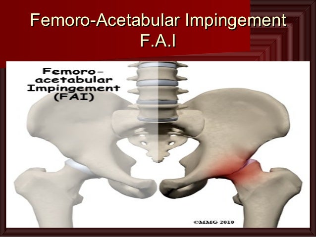 Femoroacetabular impingement