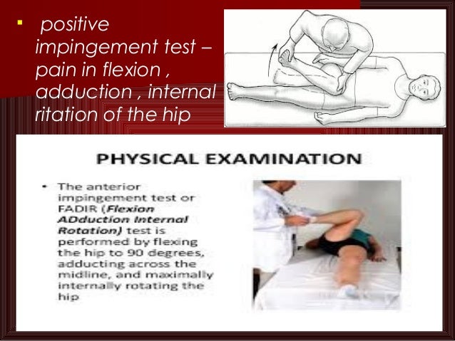 Femoroacetabular impingement