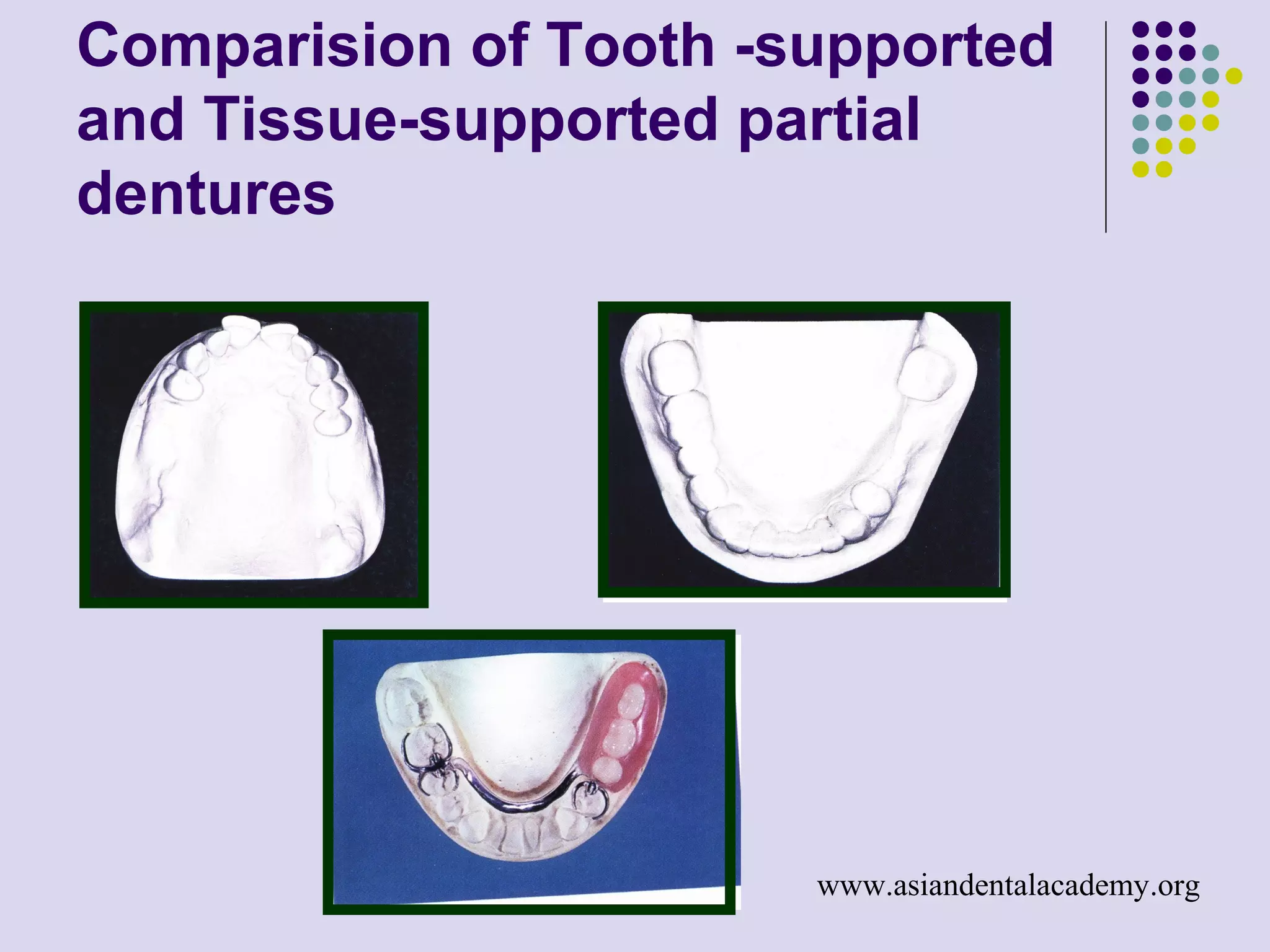 biomechanics of removable partial denture | PPT