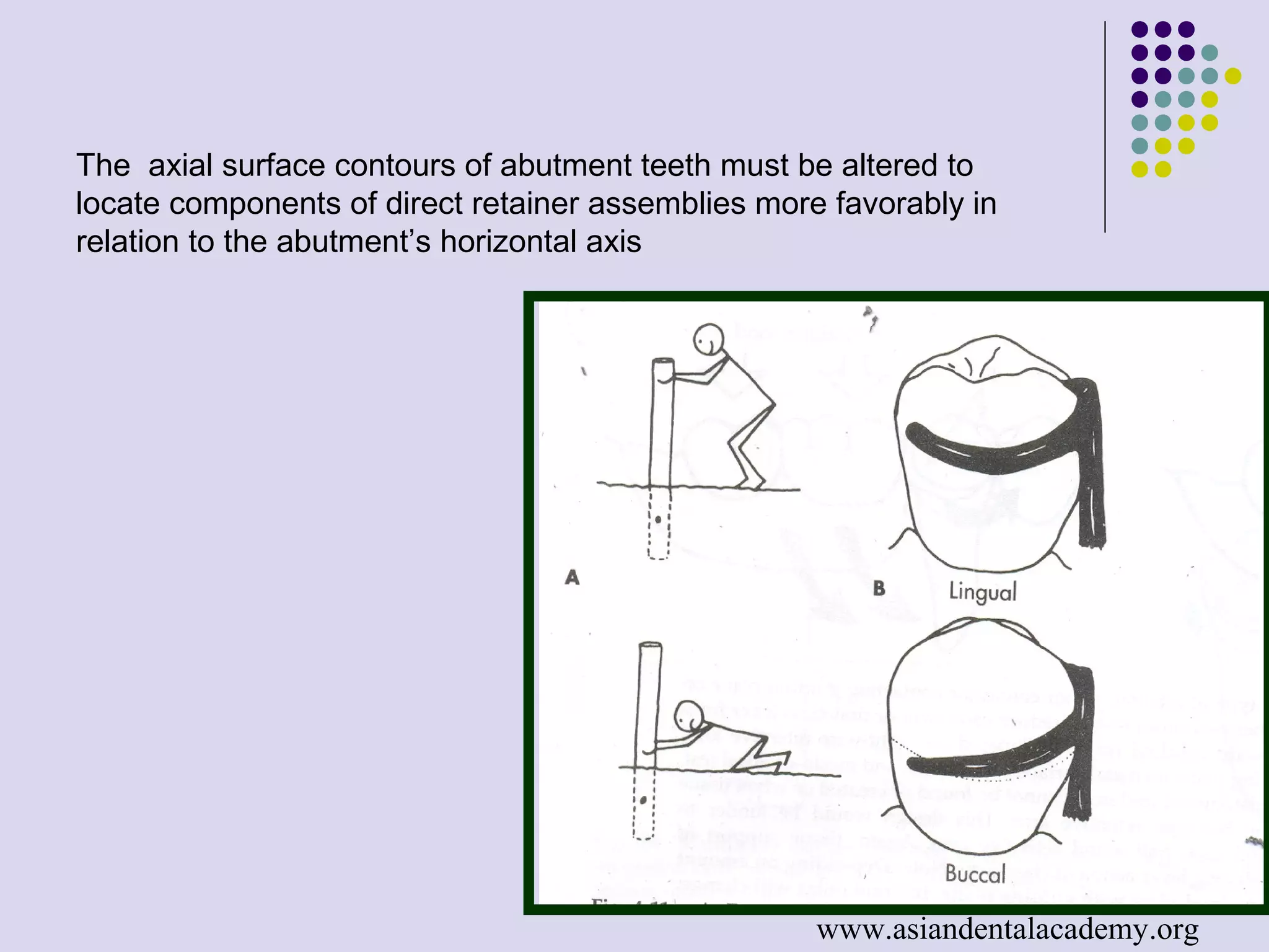 biomechanics of removable partial denture | PPT