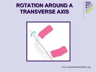 biomechanics of removable partial denture | PPT