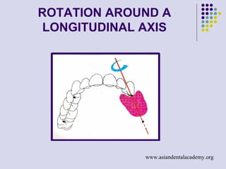 biomechanics of removable partial denture | PPT