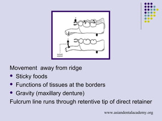 biomechanics of removable partial denture | PPT