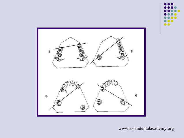 biomechanics of removable partial denture | PPT