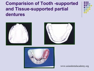 biomechanics of removable partial denture | PPT