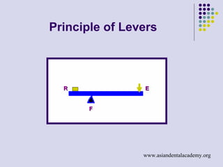 biomechanics of removable partial denture | PPT