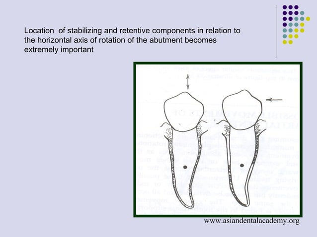 biomechanics of removable partial denture | PPT
