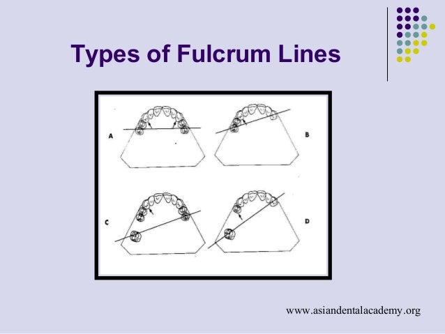 biomechanics of removable partial denture