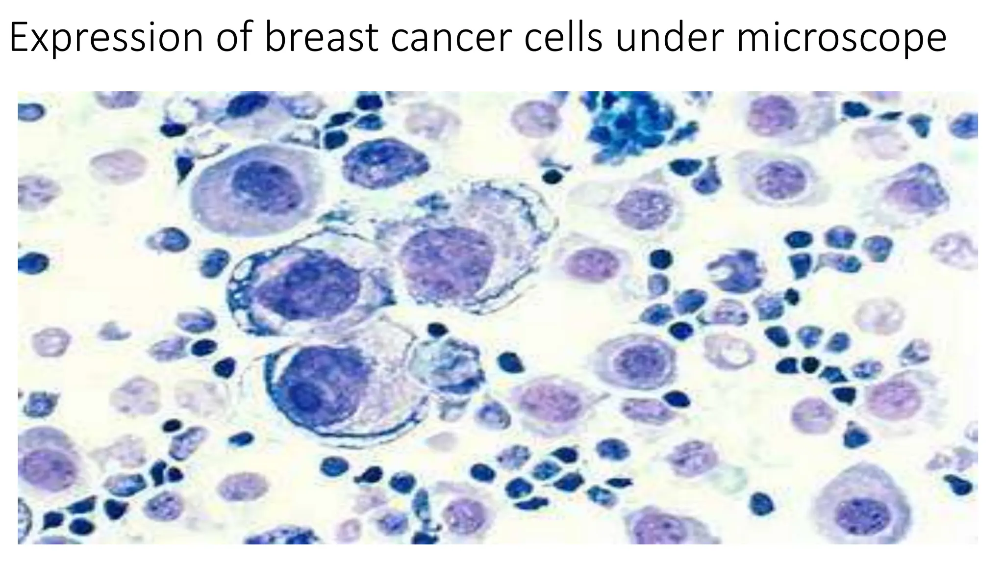 BREAST CANCER PPT: A GENERAL OVERVIEW IN HISTOPATHOLOGY | PPTX