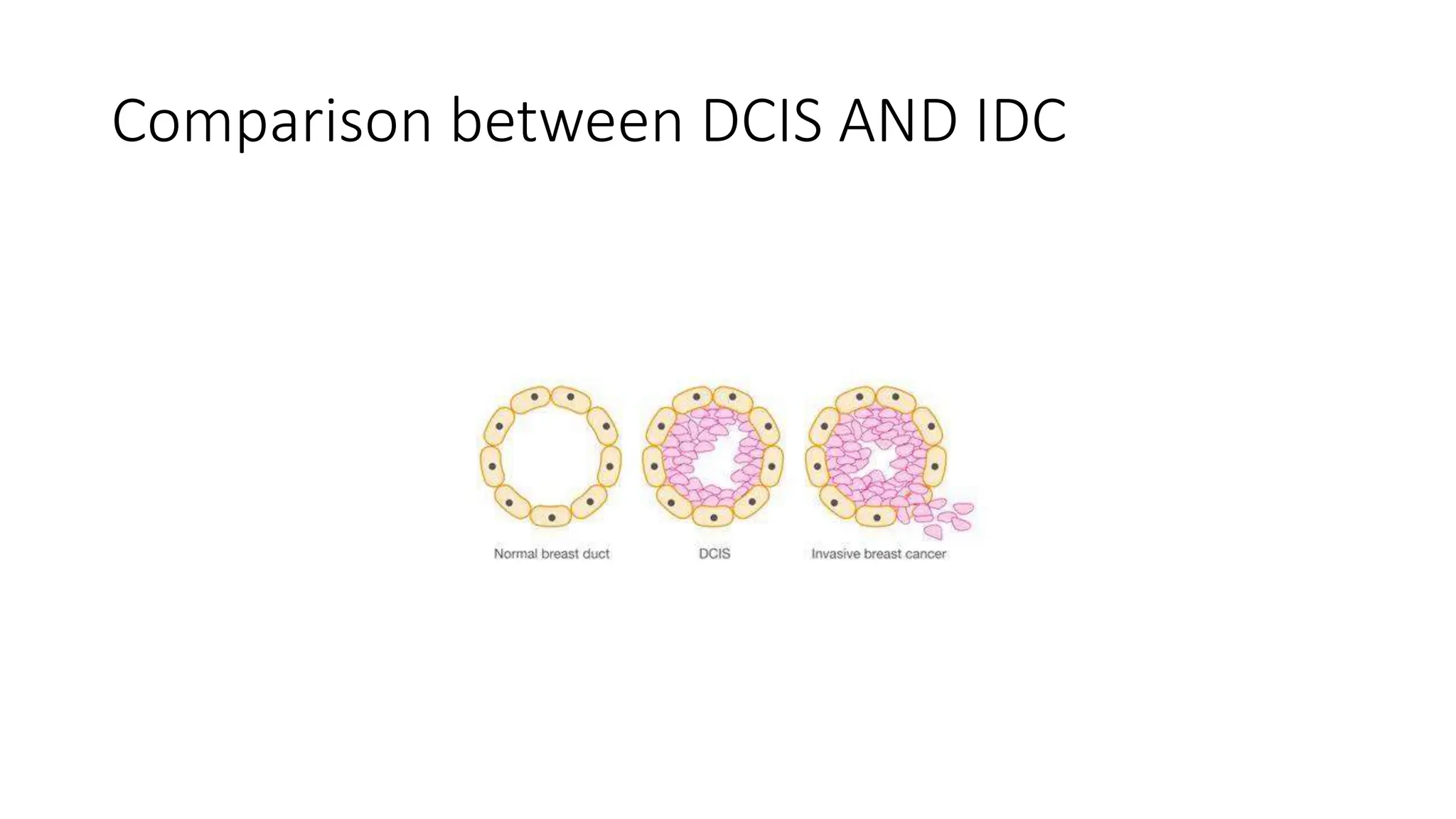 BREAST CANCER PPT: A GENERAL OVERVIEW IN HISTOPATHOLOGY | PPTX