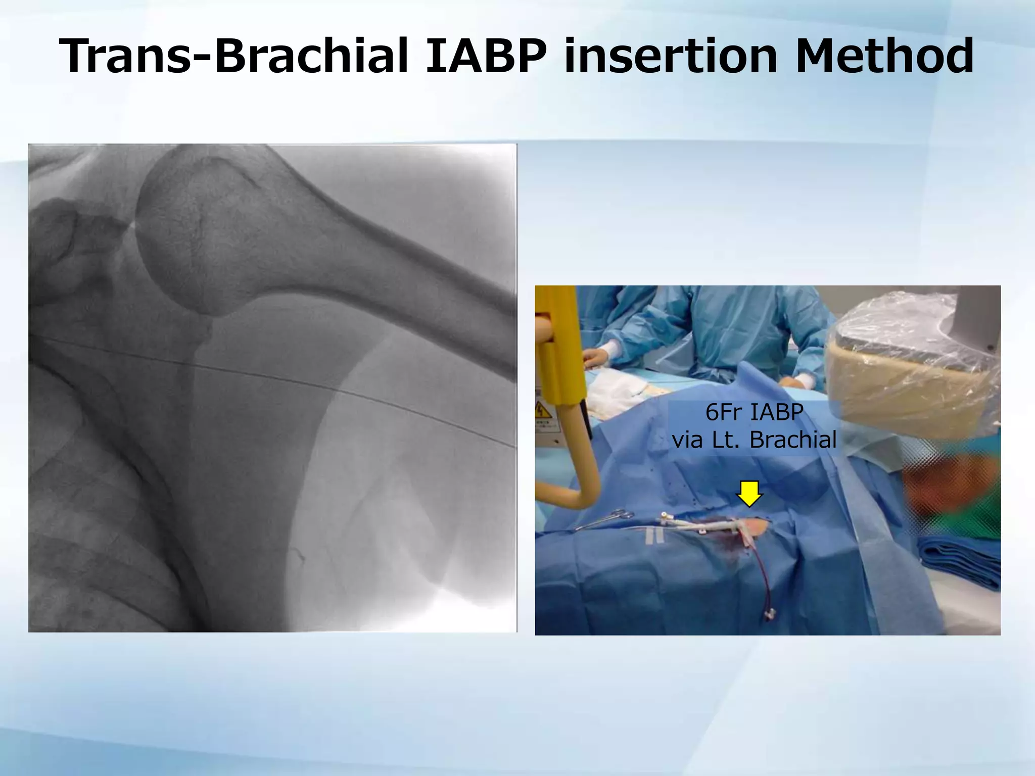 07 Ikari aimradial20170922 Brachial IABP | PPTX