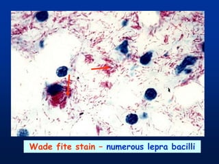 07 infectious disease mycobacteria | PPT