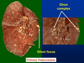 07 infectious disease mycobacteria | PPT