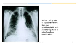 07 Idiopathic Pulmonary Fibrosis Saifur Rahman.pptx