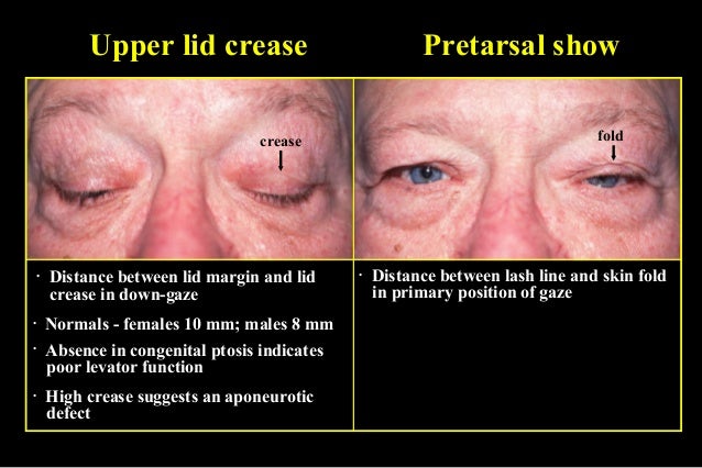 Ptosis