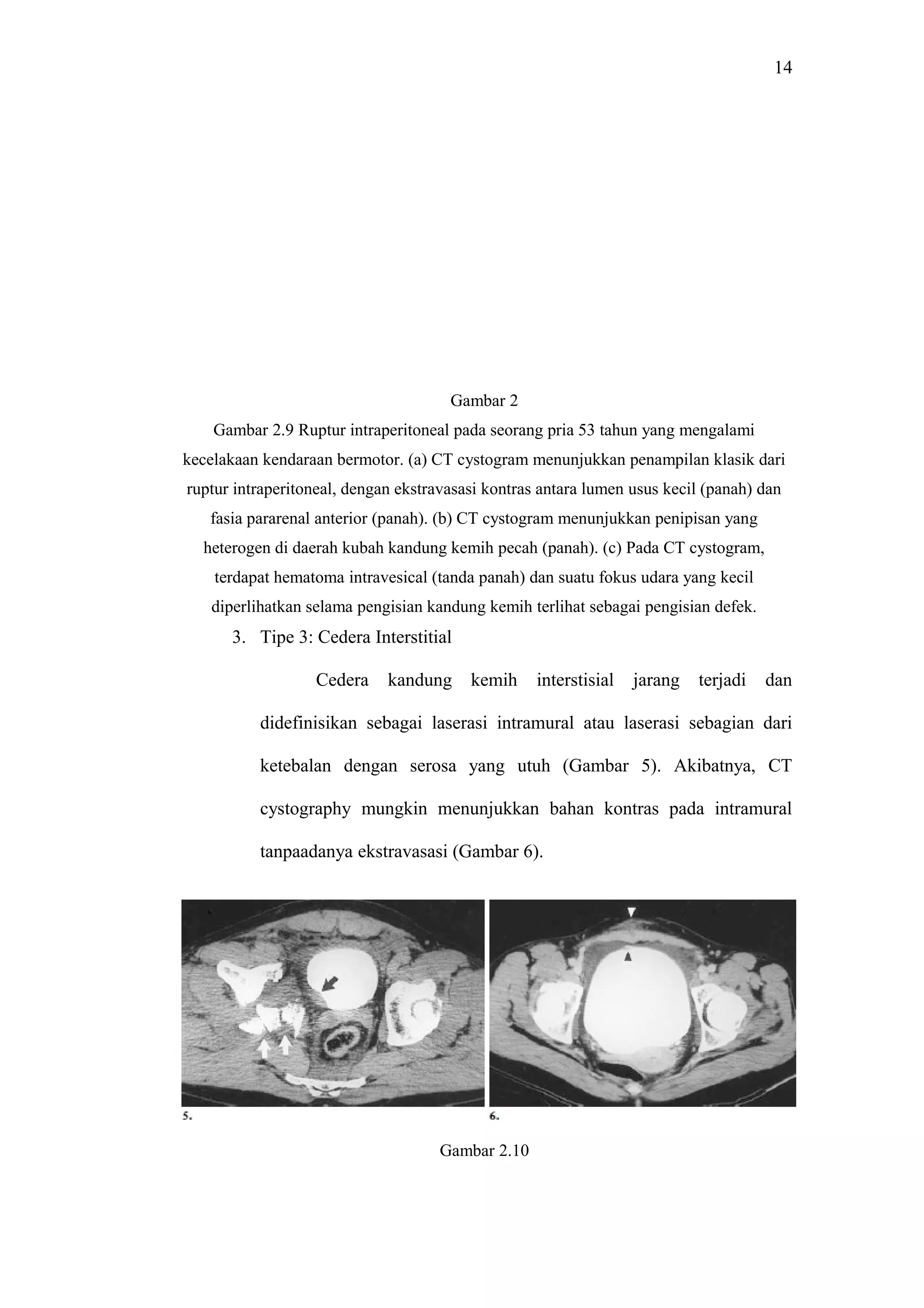 Trauma Buli-Buli (Vesika Urinaria) | DOC