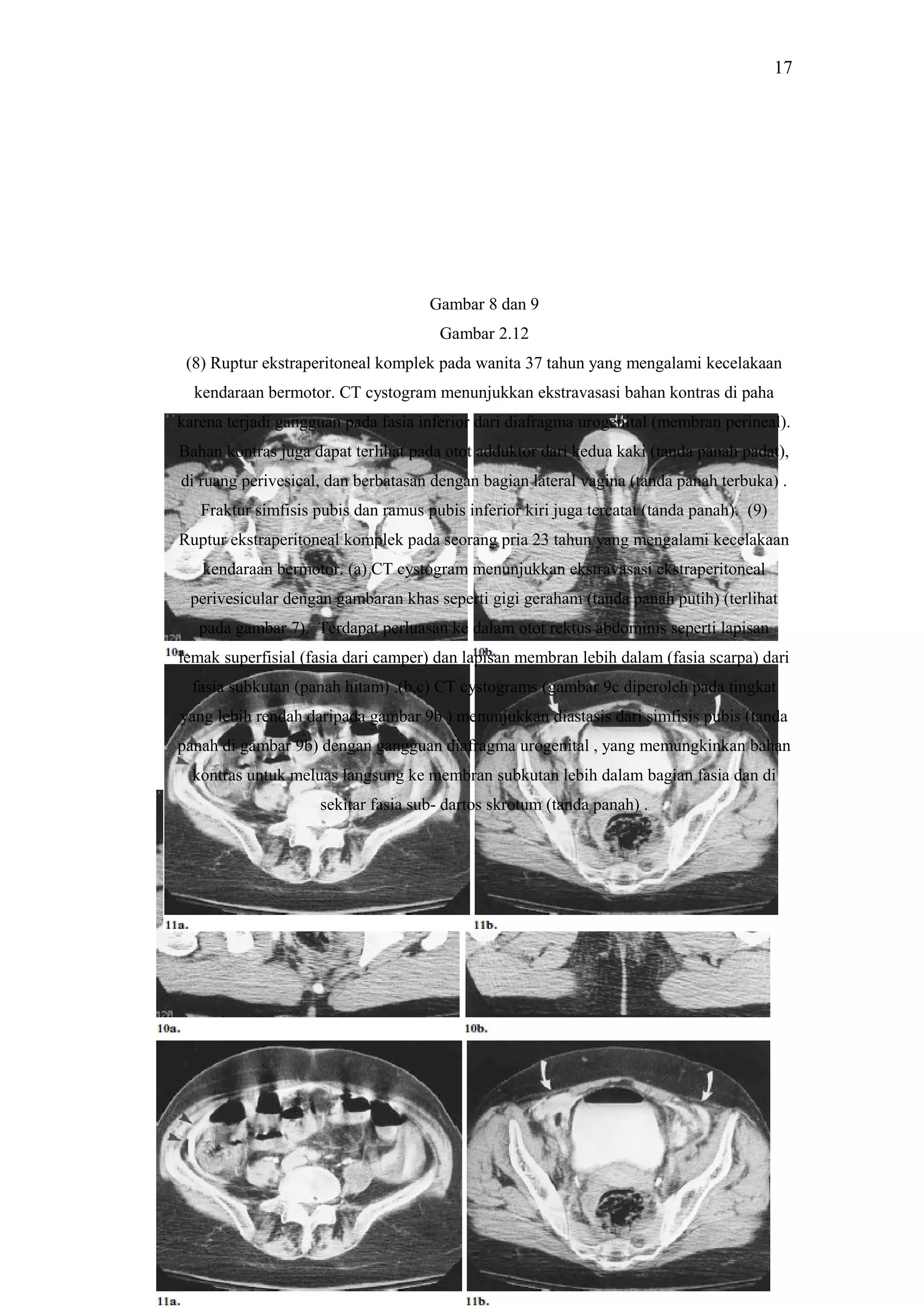 Trauma Buli-Buli (Vesika Urinaria) | DOC