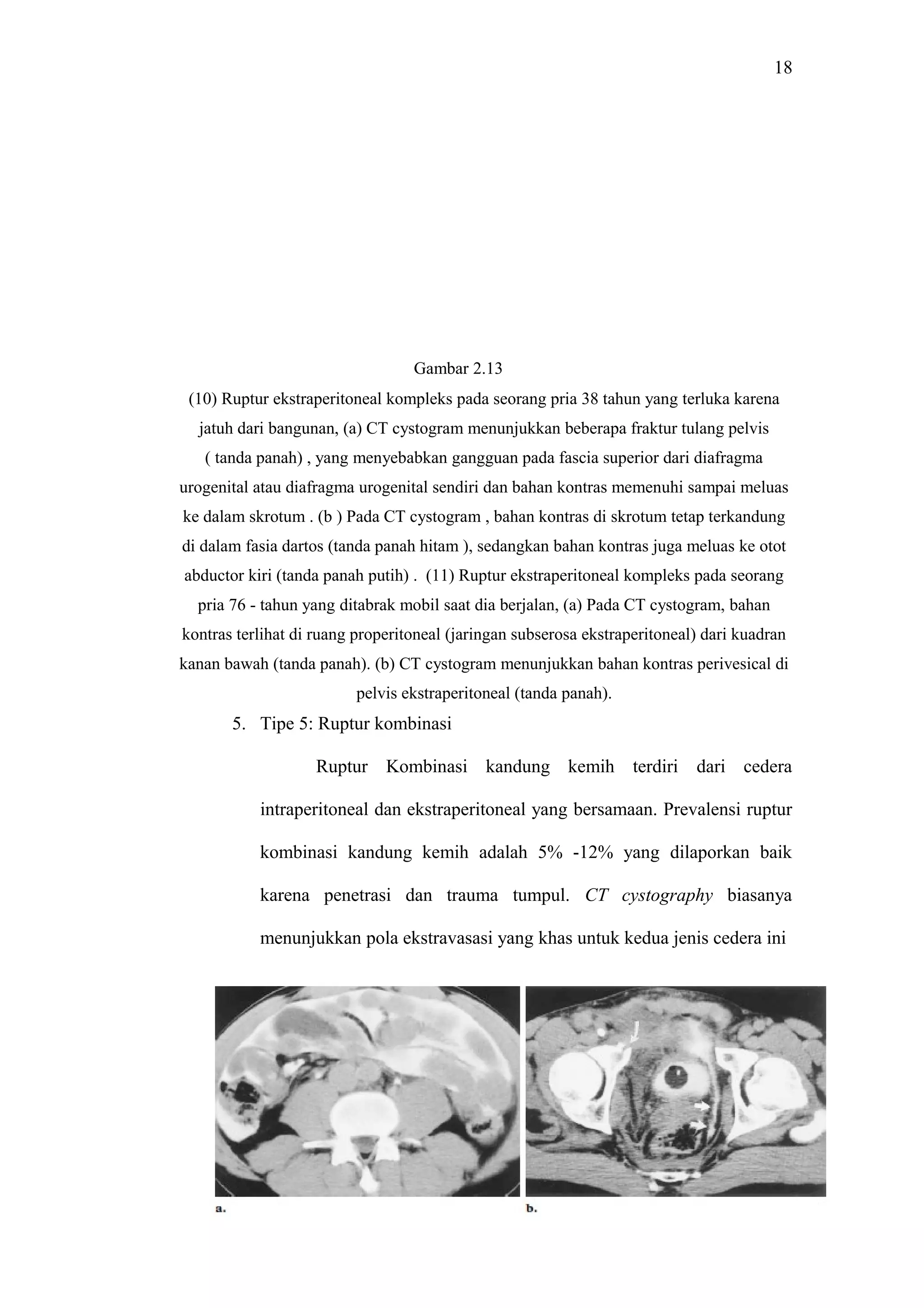 Trauma Buli-Buli (Vesika Urinaria) | DOC