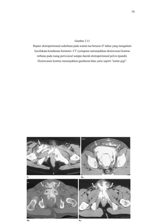 Trauma Buli-Buli (Vesika Urinaria) | DOC