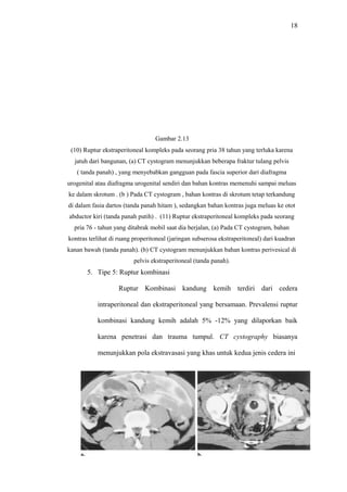 Trauma Buli-Buli (Vesika Urinaria) | DOC