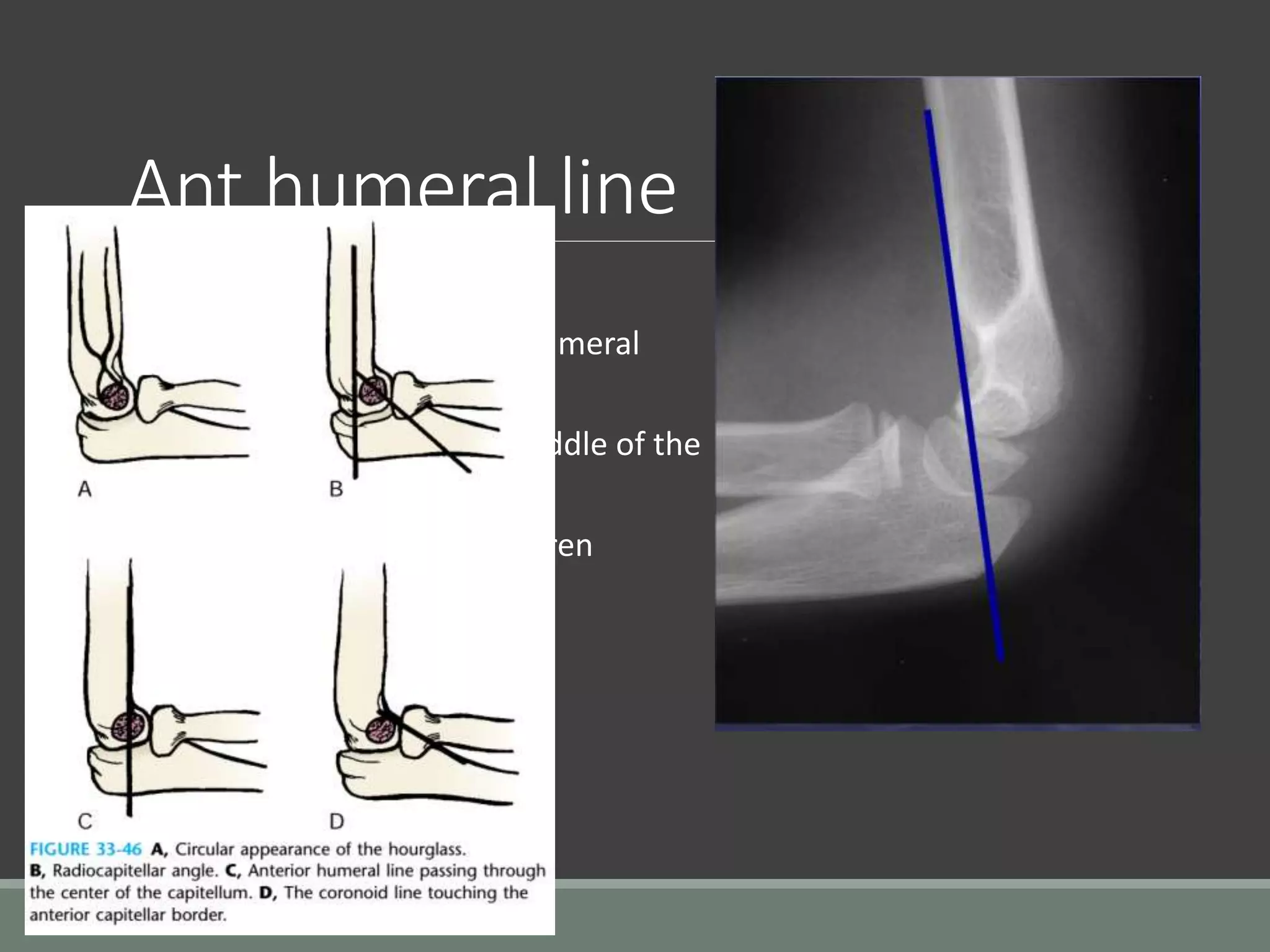 paediatric injuries around the elbow. | PPTX