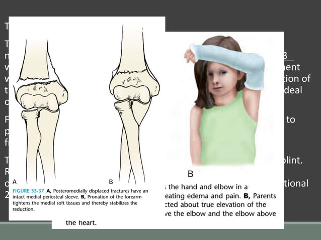 paediatric injuries around the elbow. | PPTX | Death, Injury, or ...