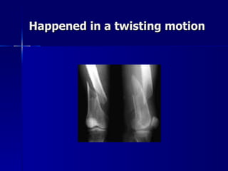 07 Fractures | PPT