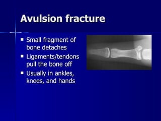 07 Fractures | PPT