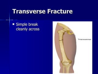 07 Fractures | PPT