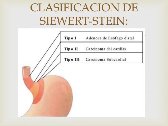 08.tratamiento de cancer de esofago