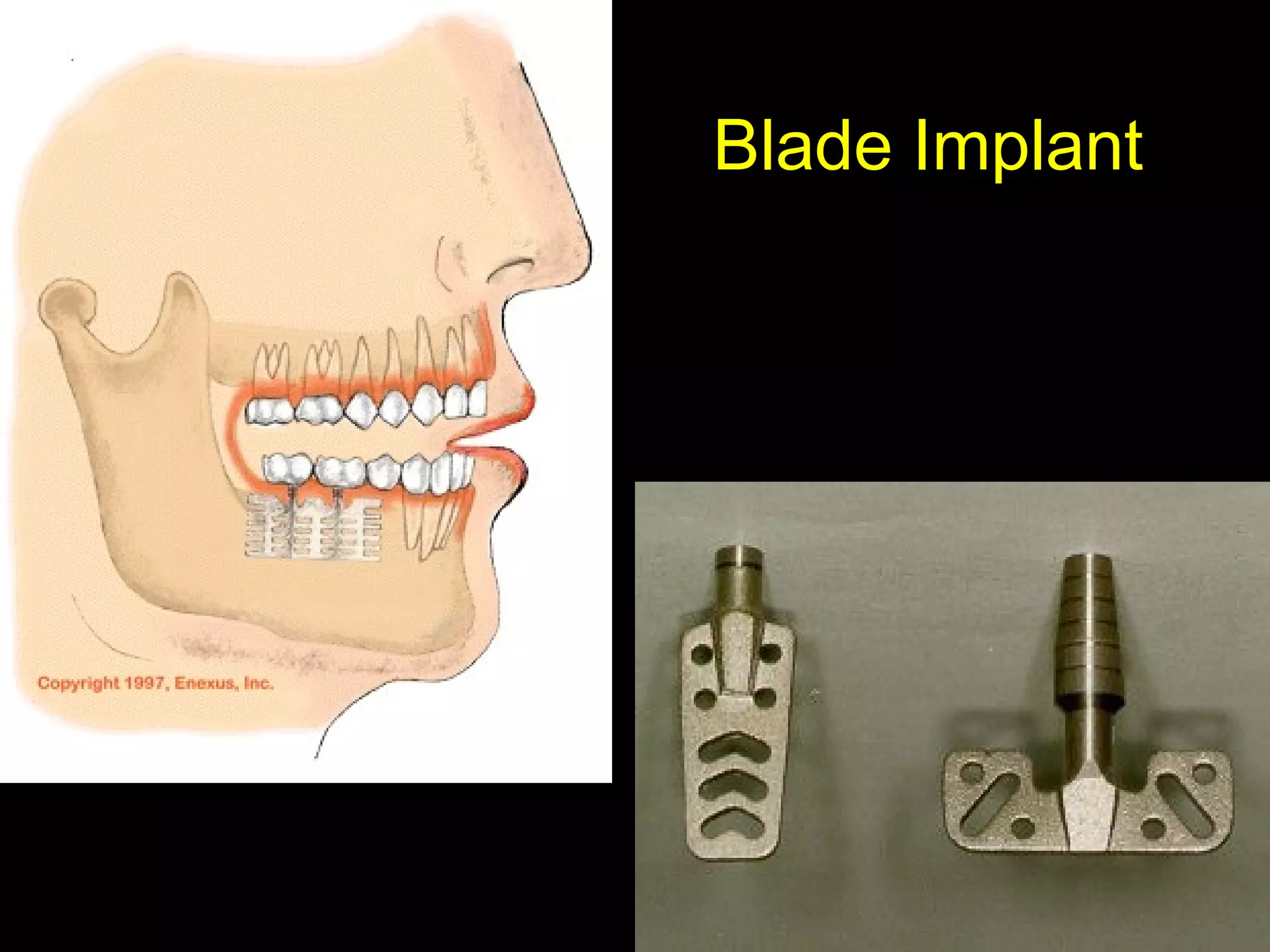 Dental implants. surgical stages | PPT