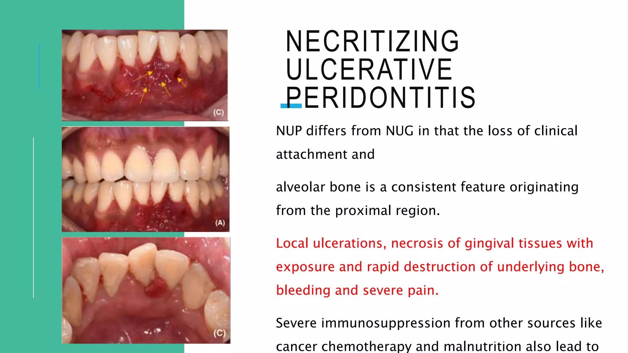 classification of periodontal diseases | PPTX