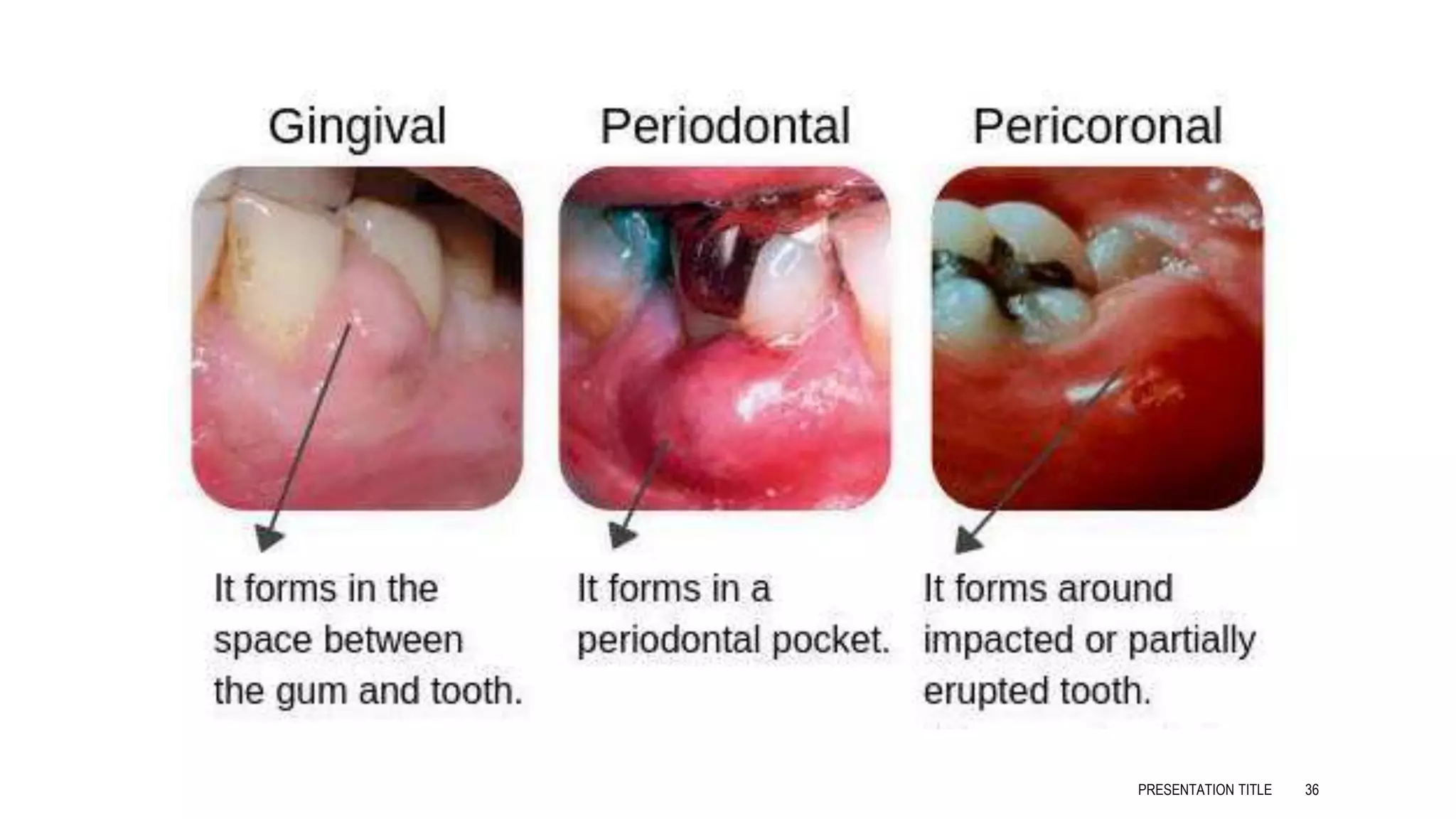 classification of periodontal diseases | PPTX