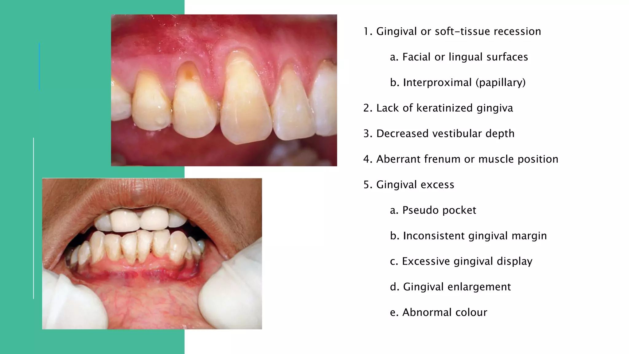 classification of periodontal diseases | PPTX