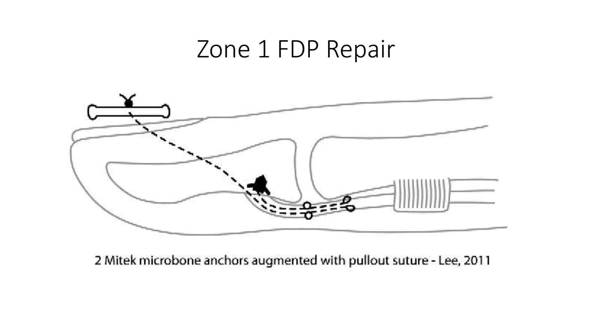 Hand flexor tendon repair basics 40 characters | PPT
