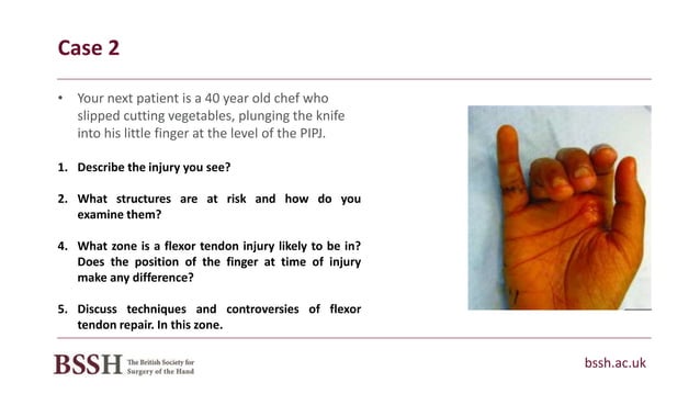 Hand flexor tendon repair basics 40 characters | PPT