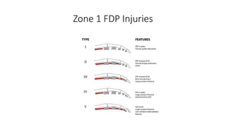 Hand flexor tendon repair basics 40 characters | PPT