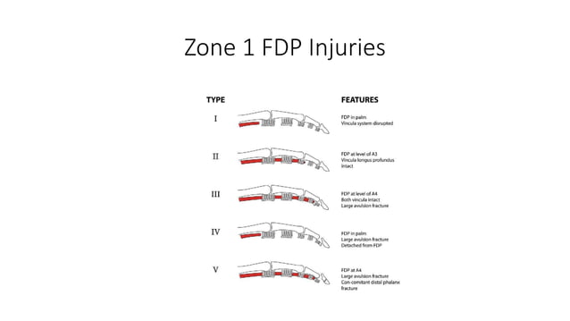 Hand flexor tendon repair basics 40 characters | PPT